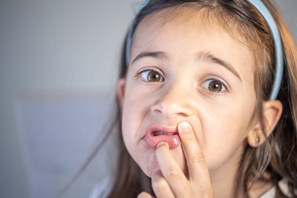 Afte bucale la copii: ce sunt, cauze, simptome, tratament - Dental Elite