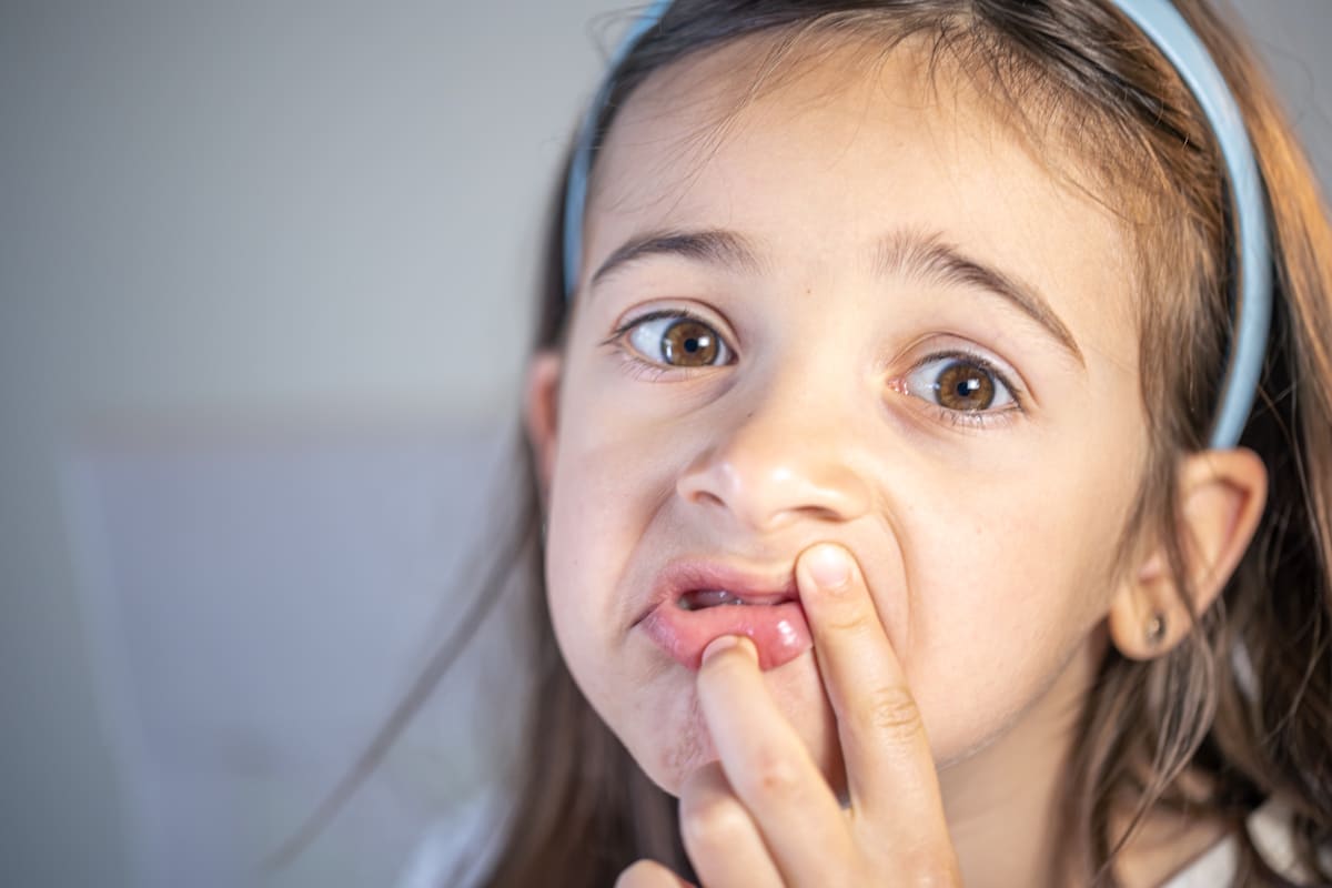 Afte bucale la copii: ce sunt, cauze, simptome, tratament - Dental Elite